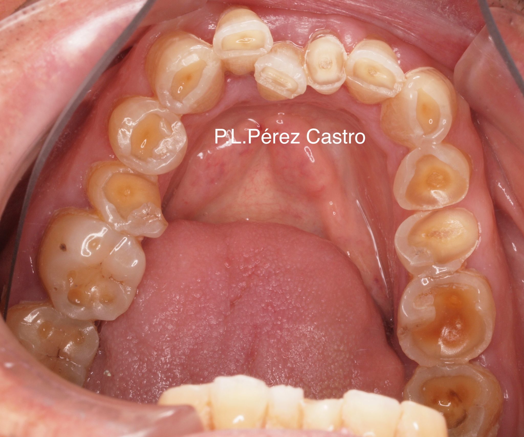 Oclusión en la clínica diaria: Parte III – 1 ” Dimensión Vertical