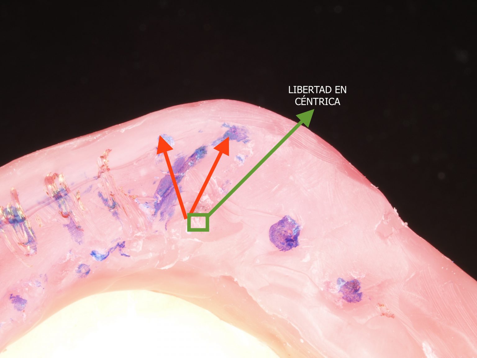 Placa de Descarga: Bruxismo como enfermedad. Dr. Pedro Pérez Castro.