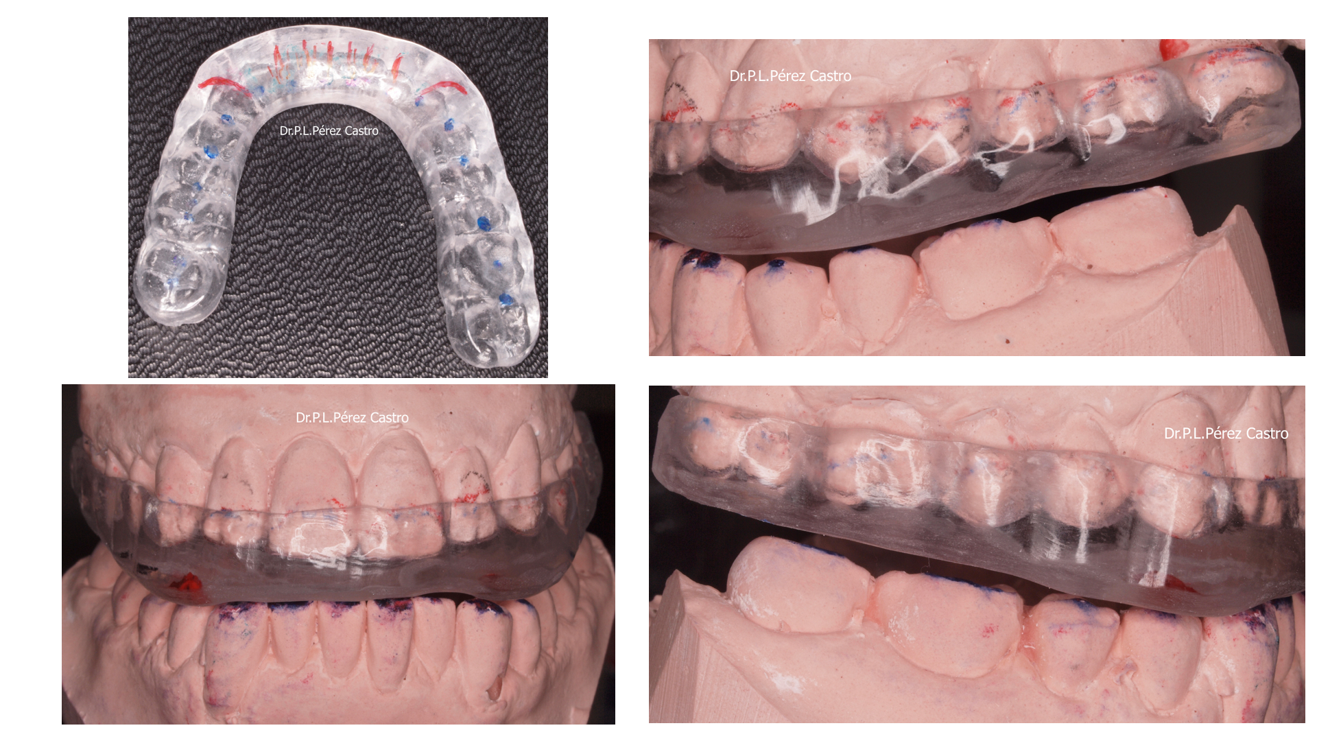 Placa de Descarga: Bruxismo como enfermedad. Dr. Pedro Pérez Castro.