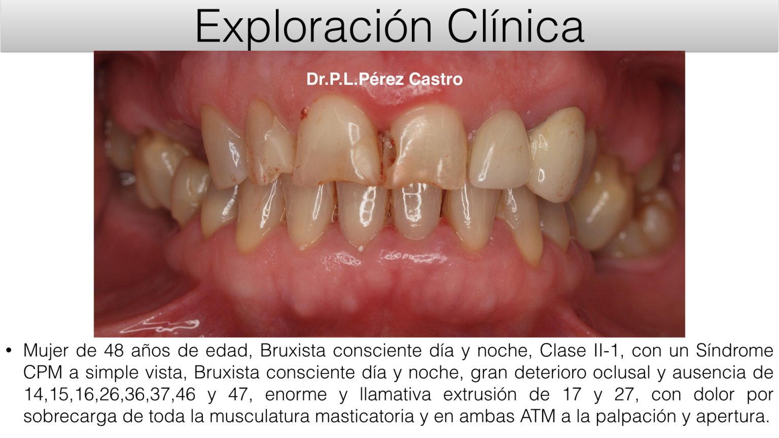 Colapso Posterior de Mordida 2 Caso Clínico